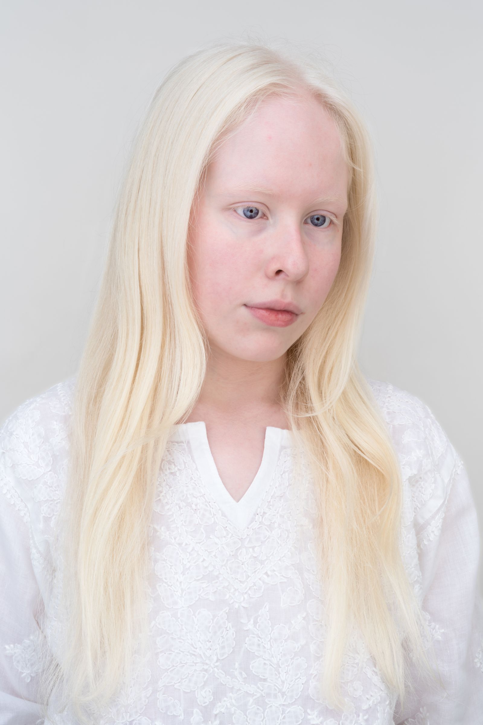 ALBINOS, BEING DIFFERENT - PhMuseum