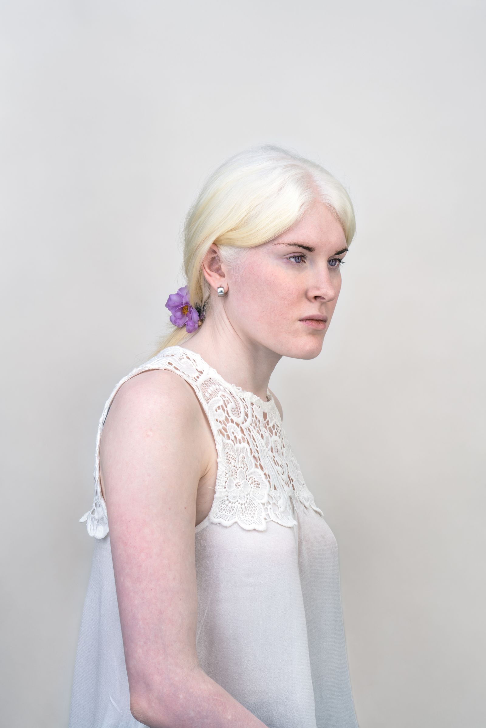 ALBINOS, BEING DIFFERENT - PhMuseum