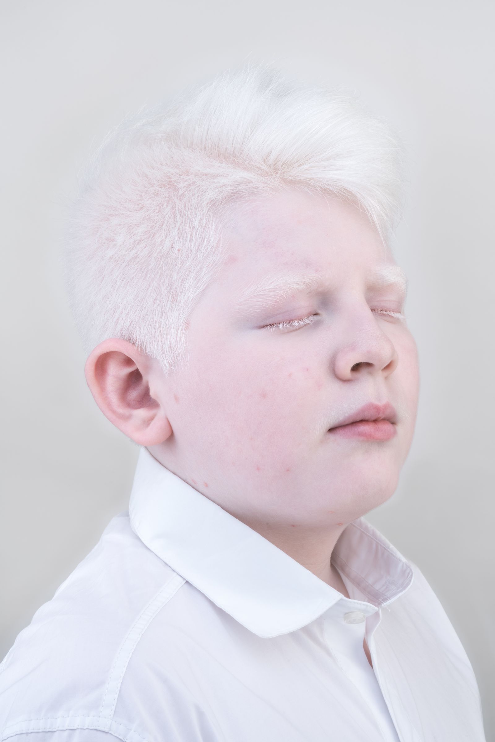 ALBINOS, BEING DIFFERENT - PhMuseum