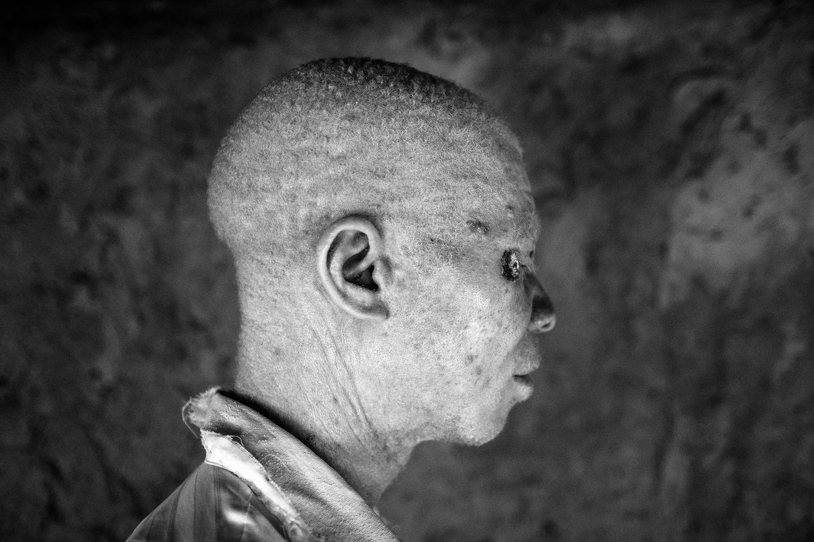 The hunted - albinos - PhMuseum