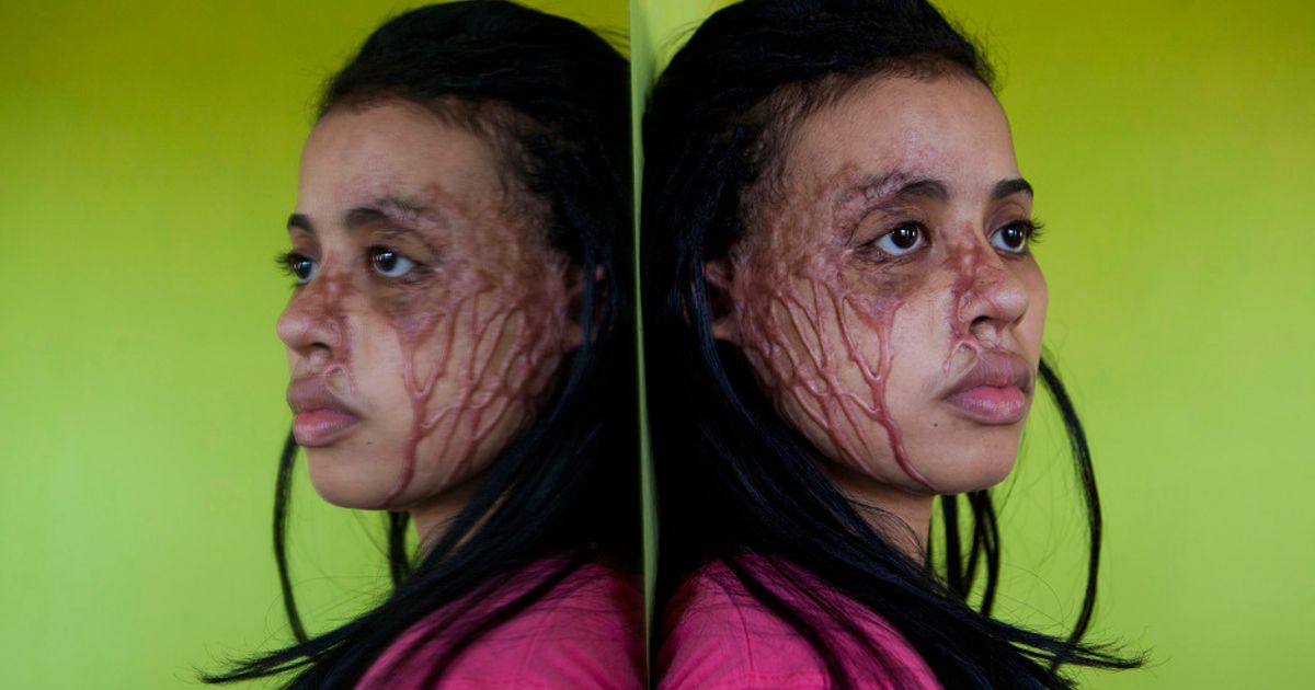 Women victims of acid - PhMuseum