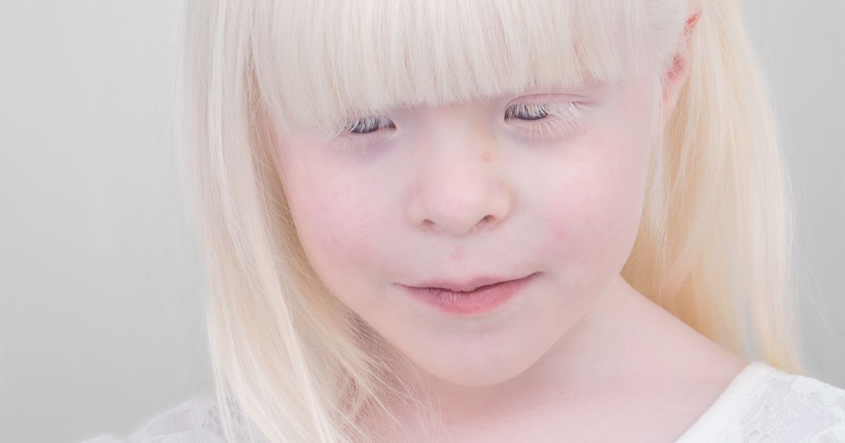 ALBINOS, BEING DIFFERENT - PhMuseum